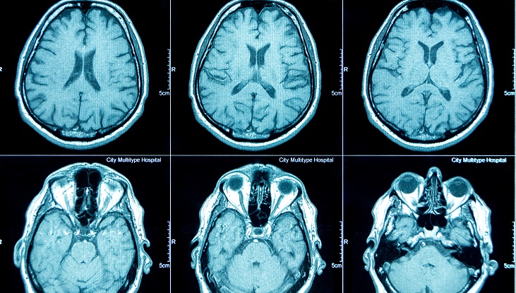 Using Magnetic Resonance Imaging to investigate Glymphatic System ...