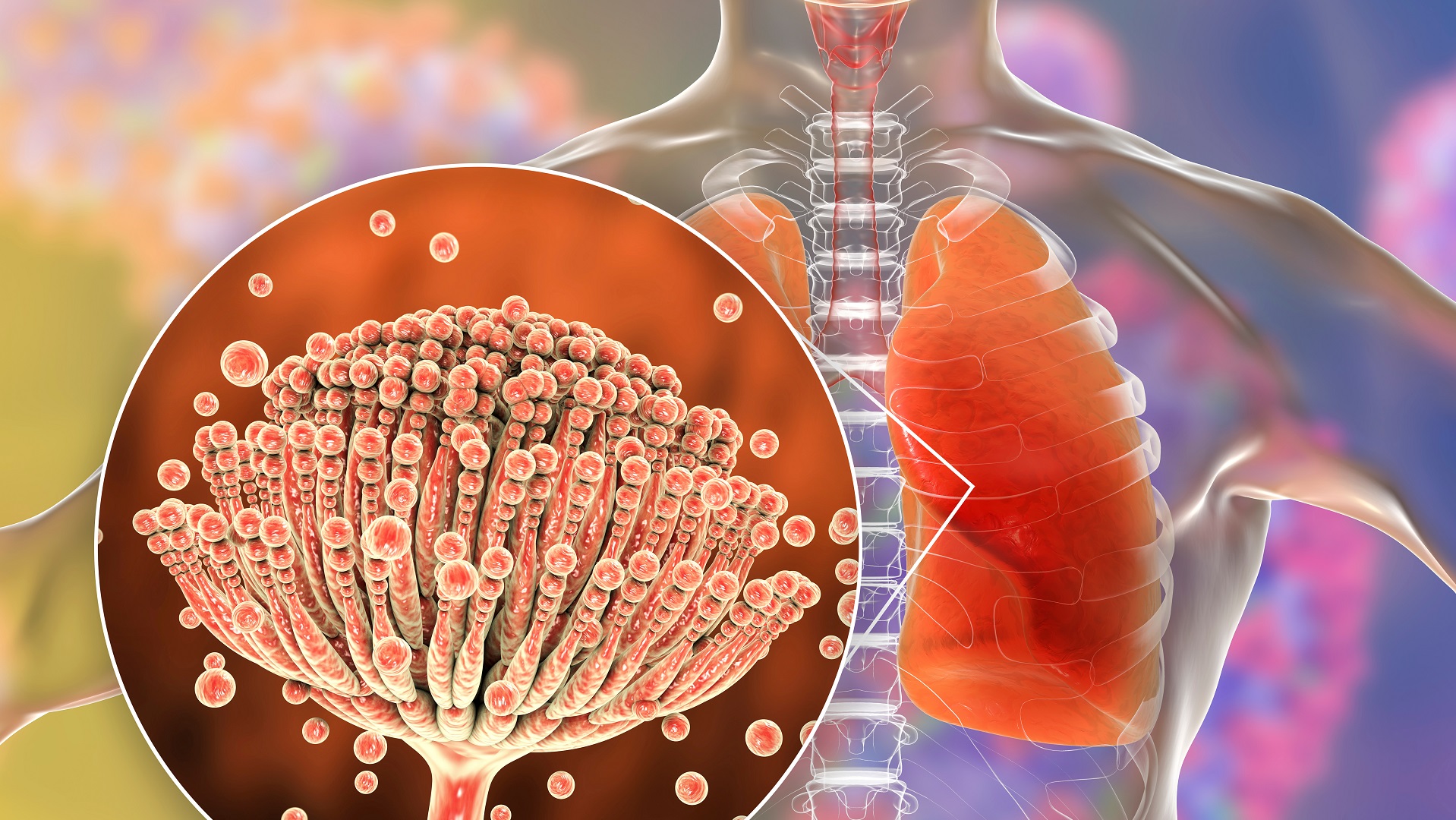 Commensal Fungi in the Lung: Innocent Bystanders or Pathogenic ...